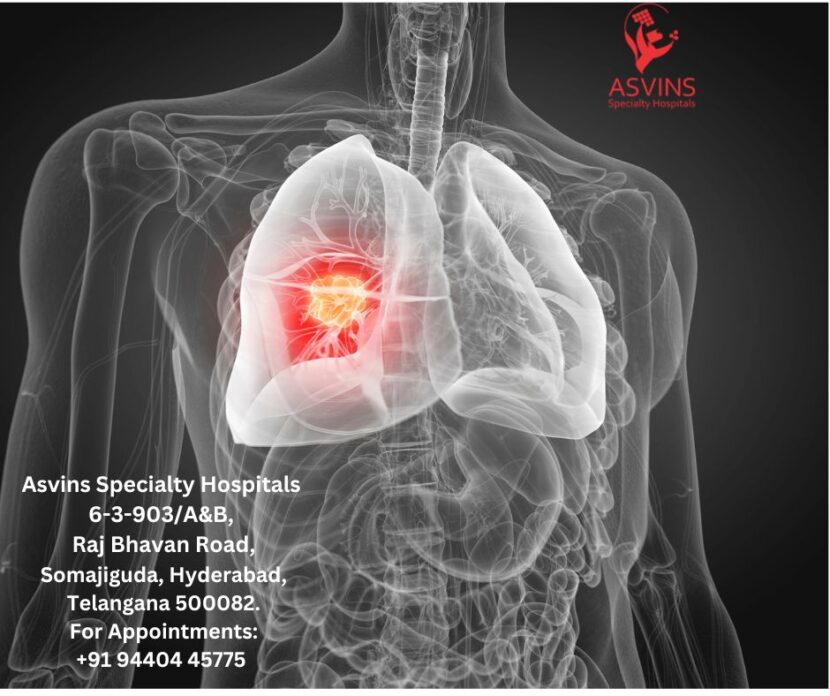 Understanding Tnm Staging For Lung Cancer Asvins Specialty Hospitals 7208